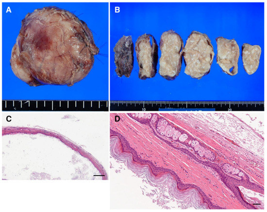 A Case of a Giant Sublingual Epidermoid Cyst Removed by Content ...