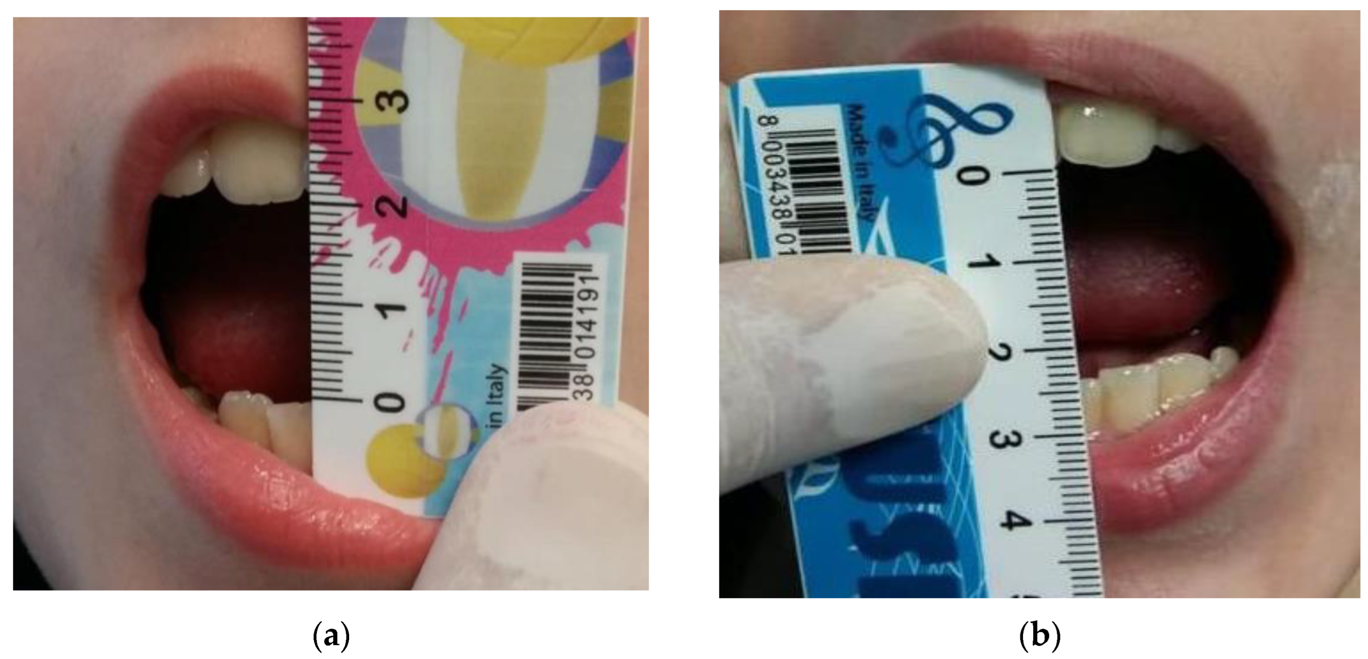 Oral | Free Full-Text | Severe Post-Traumatic Trismus Unresponsive to ...