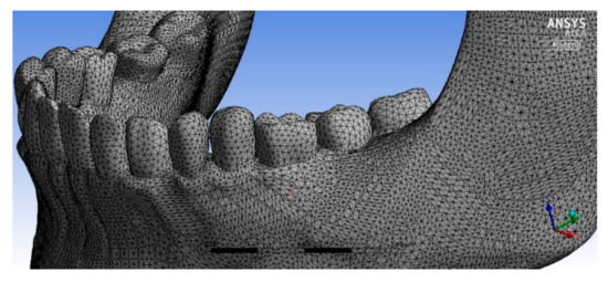 Three-Dimensional Finite Element Analysis on Mandibular Biomechanics ...