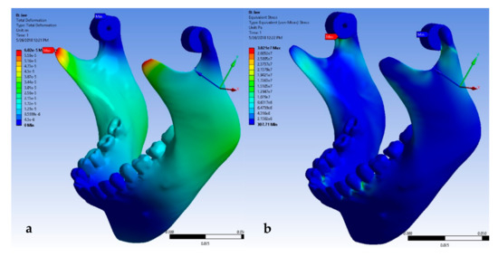 Three-Dimensional Finite Element Analysis on Mandibular Biomechanics ...