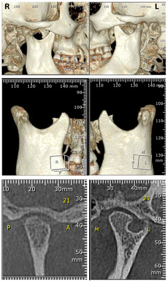 Bilateral Condylar Fracture: A 10-Year Case Report Follow-Up after a ...
