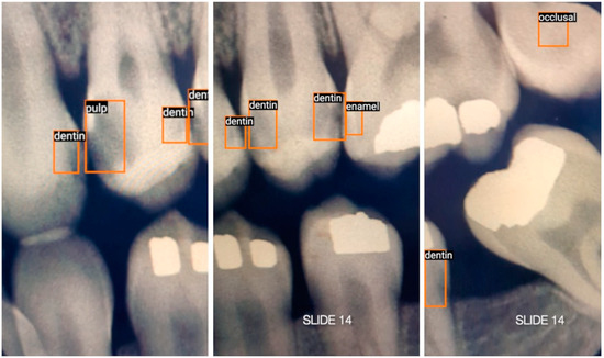 Real-Time Caries Detection of Bitewing Radiographs Using a Mobile Phone and an Artificial Neural ...
