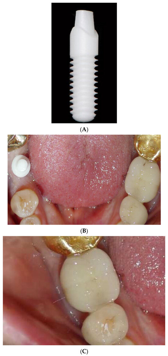 Zirconia Implants: A Mapping Review