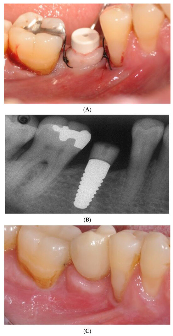 Zirconia Implants: A Mapping Review