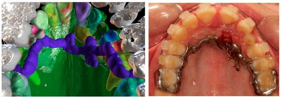 Digital Model in Orthodontics: Is It Really Necessary for Every ...