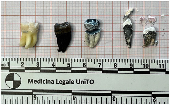 Colorimetric Study on Burnt Teeth and New Diagnostic Tool in Forensic ...