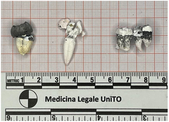 Colorimetric Study on Burnt Teeth and New Diagnostic Tool in Forensic ...