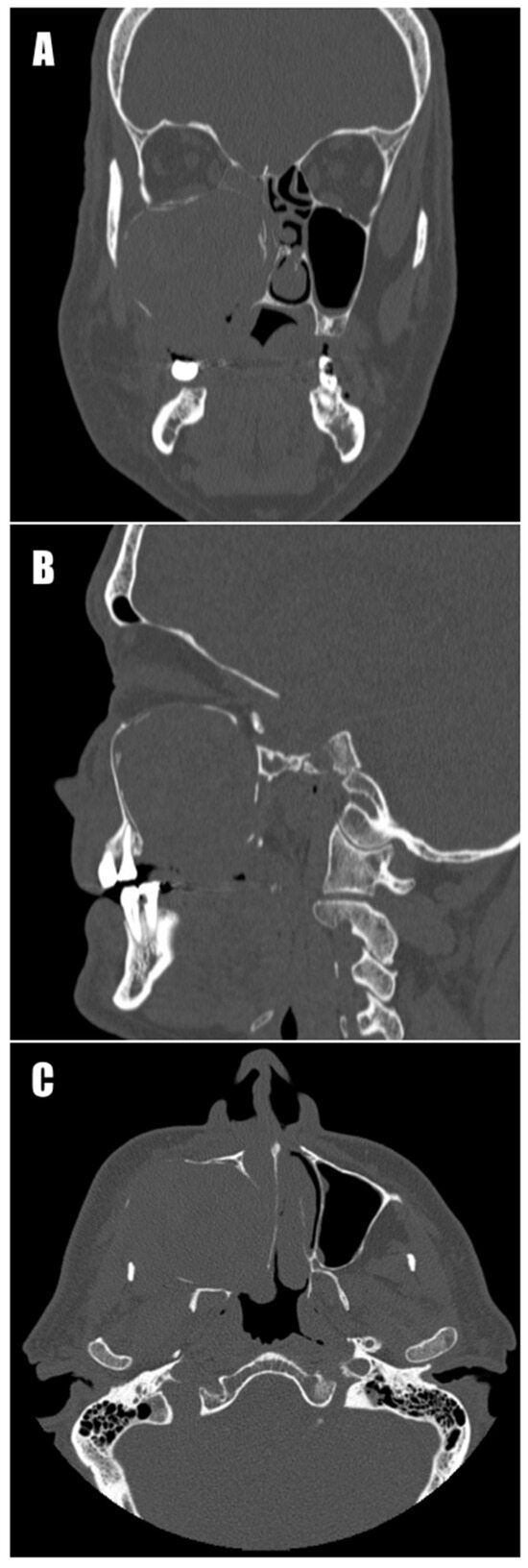 Residual Cyst Mimicking an Aggressive Neoplasm—A Life-Threatening Condition