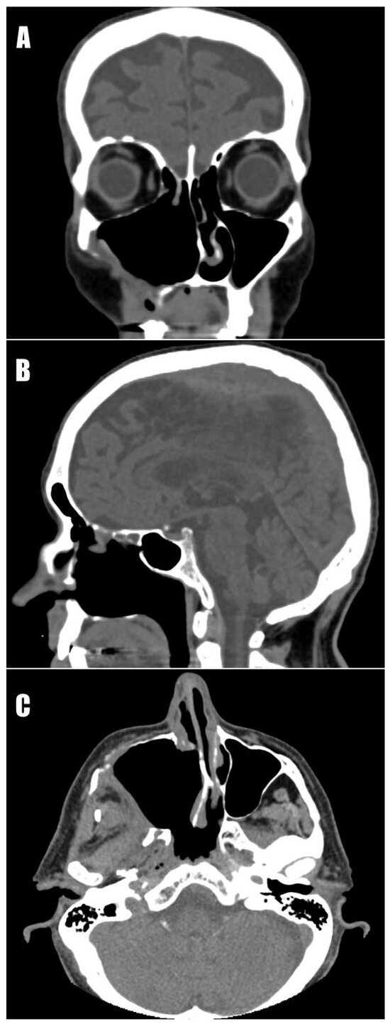 Residual Cyst Mimicking an Aggressive Neoplasm—A Life-Threatening Condition