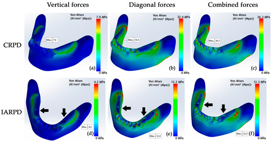 Stress Distribution in a Mandibular Kennedy Class I with Bilateral ...