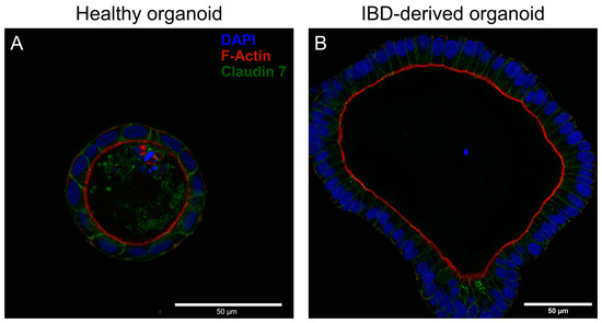 The Intricacies of Inflammatory Bowel Disease: A Preliminary Study of ...