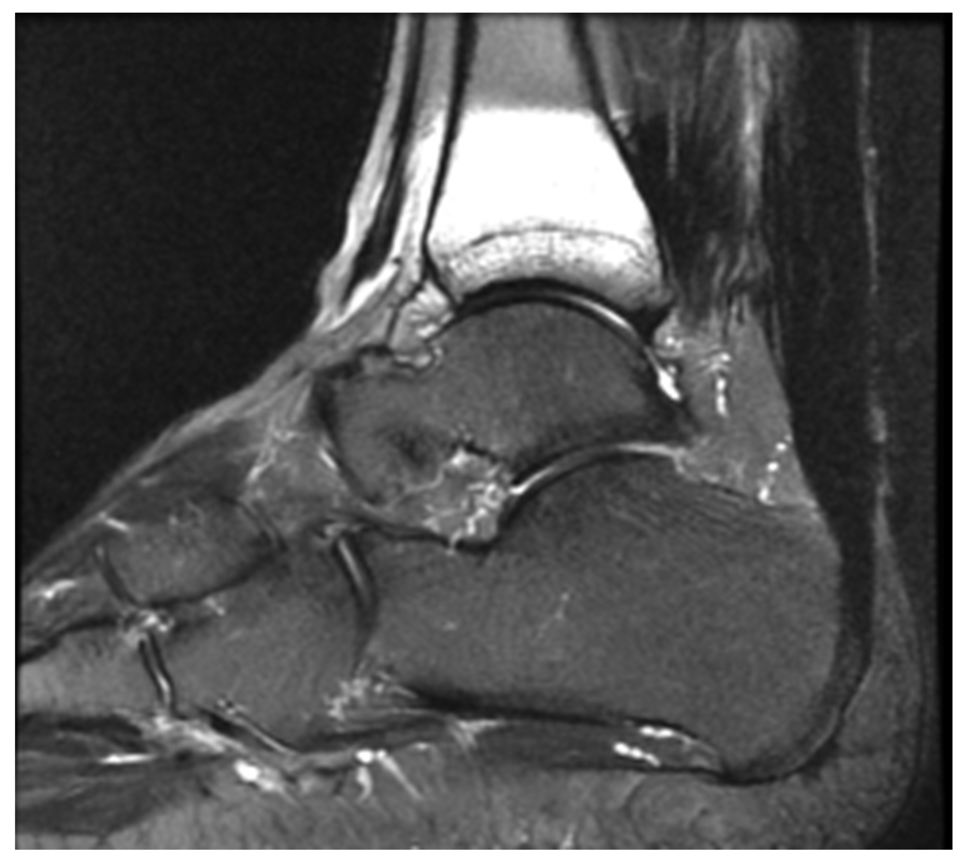 Bilateral Achilles Tendon Rupture: A Case Report and Review of the ...