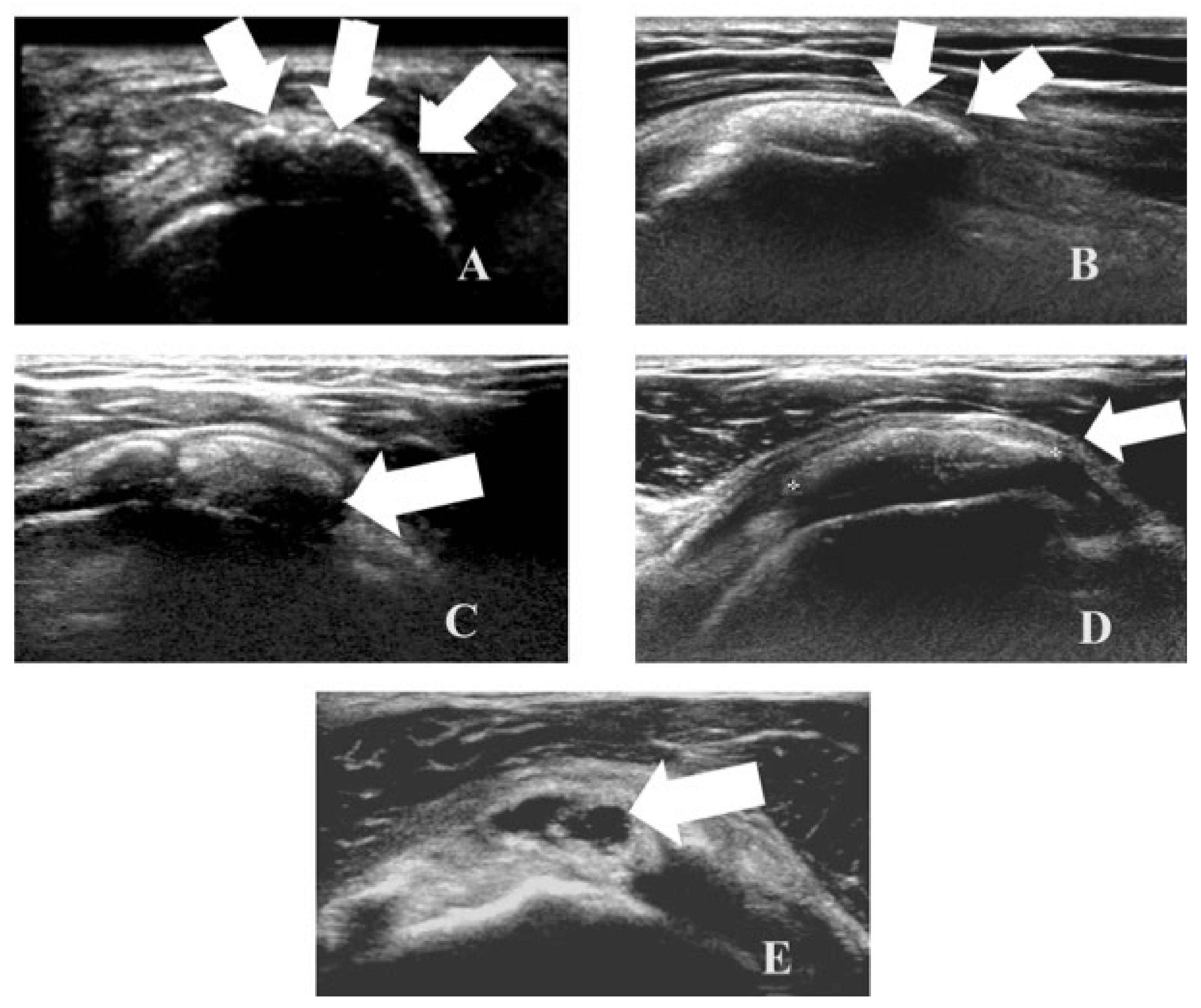 Osteology | Free Full-Text | Calcific Shoulder Tendinopathy (CT ...
