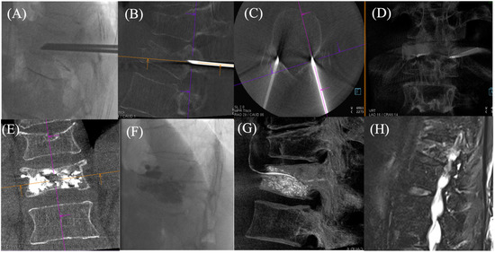 Percutaneous Vertebroplasty: A Minimally Invasive Procedure for the ...