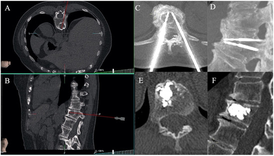 Percutaneous Vertebroplasty: A Minimally Invasive Procedure for the ...