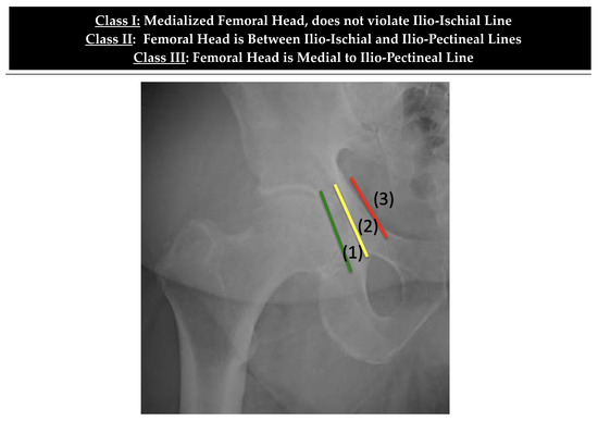 Managing Native Hip Protrusio: Simplified Classification and Surgical ...