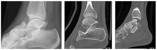 Single-Lateral-Incision Technique for Talar Neck Fractures—A Viable Option