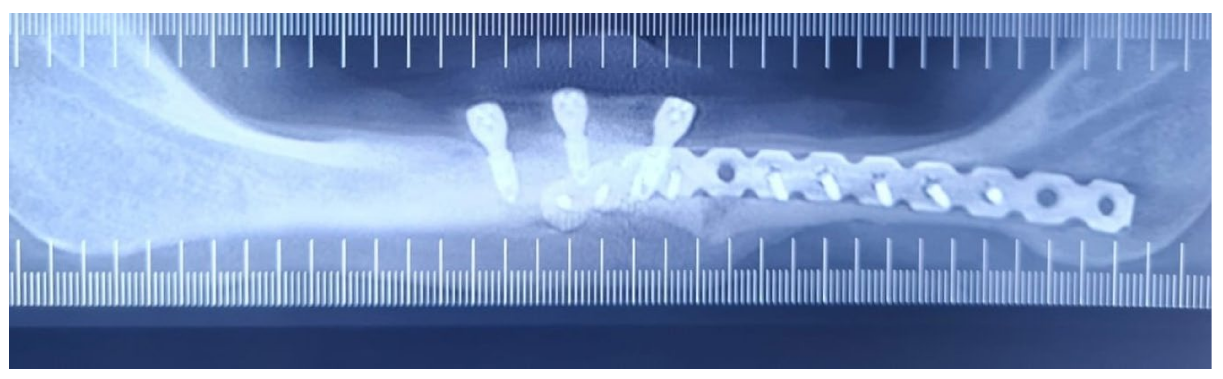 Mandibular Fracture following Dental Implant Protocol: Clinical Report ...