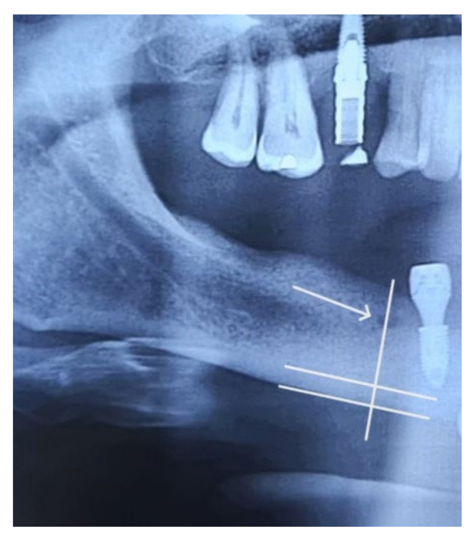 Mandibular Fracture following Dental Implant Protocol: Clinical Report ...