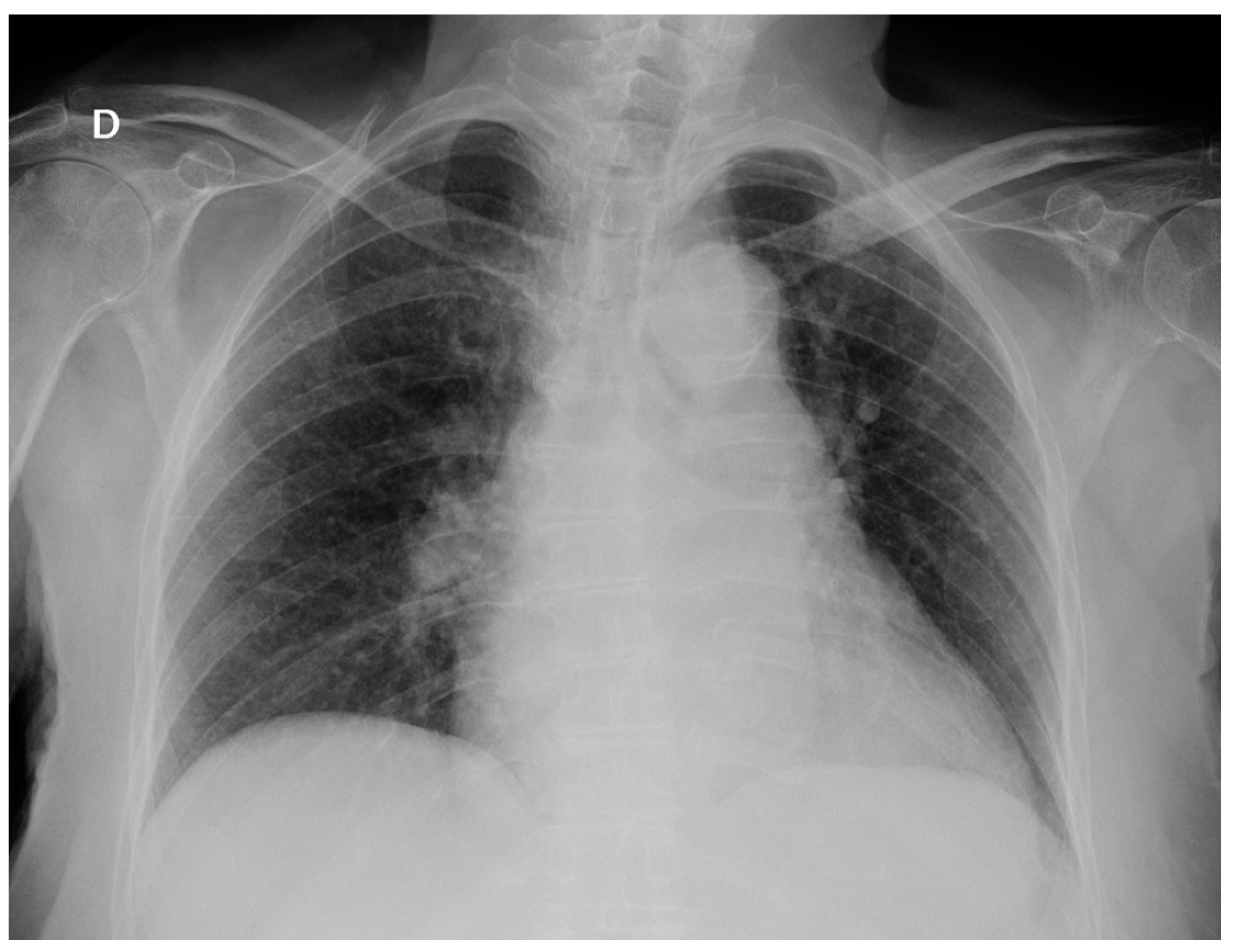 Chest X Ray Miliary Tb