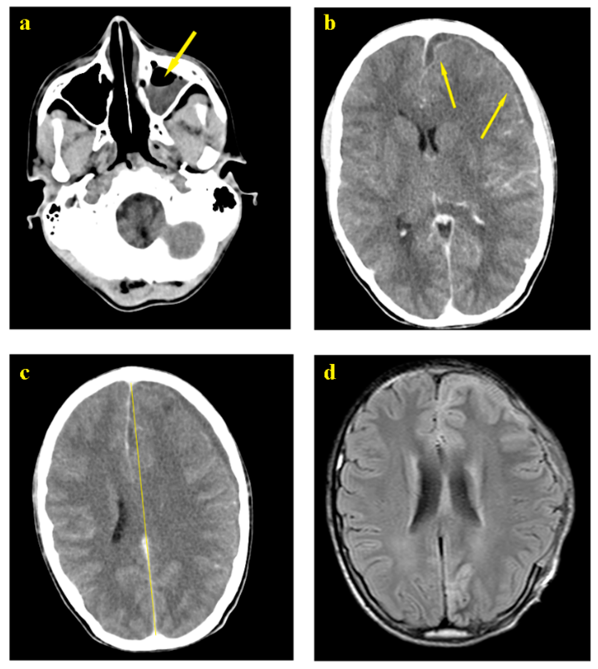 Genome Mining and Comparative Analysis of Streptococcus intermedius ...