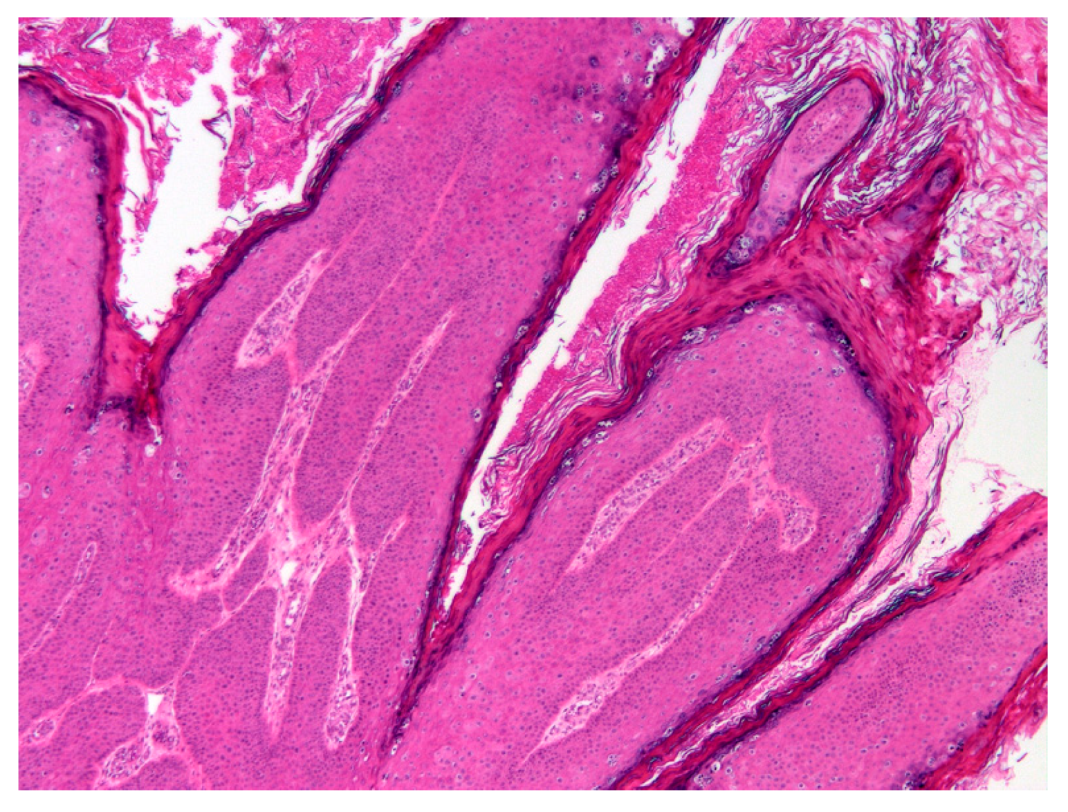 Filiform Wart Histology