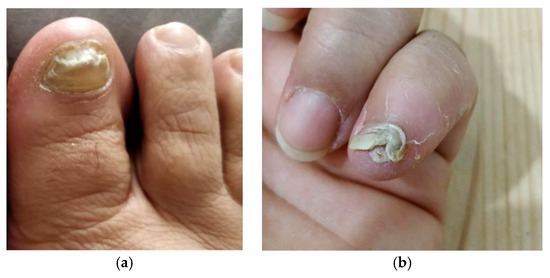 A Rare Paronychia with Superinfection with Prevotella bivia and ...
