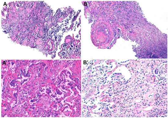 Minimally Invasive Autopsy Practice in COVID-19 Cases: Biosafety and ...