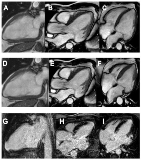 Chagas Cardiomyopathy: From Romaña Sign to Heart Failure and Sudden ...