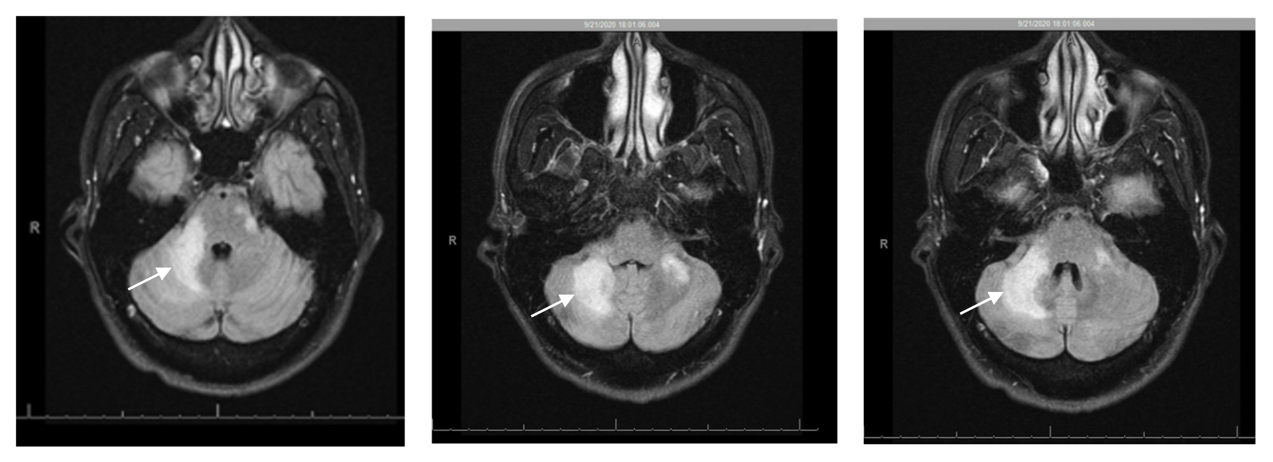 Progressive Multifocal Leukoencephalopathy Mri