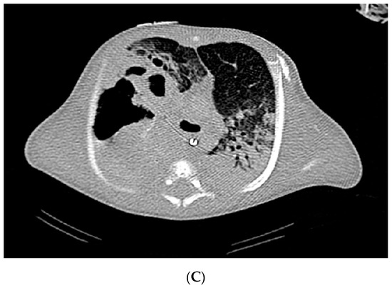 Severe Pneumonia in Neonates Associated with Legionella pneumophila ...