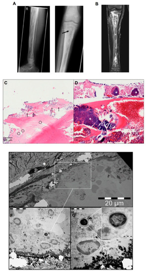 Intracellular S. aureus in Osteoblasts in a Clinical Sample from a ...