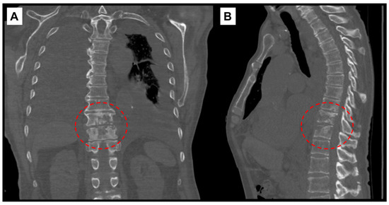 Pott Disease: A Tale of Two Cases