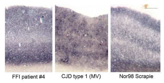 Defining the Prion Type of Fatal Familial Insomnia
