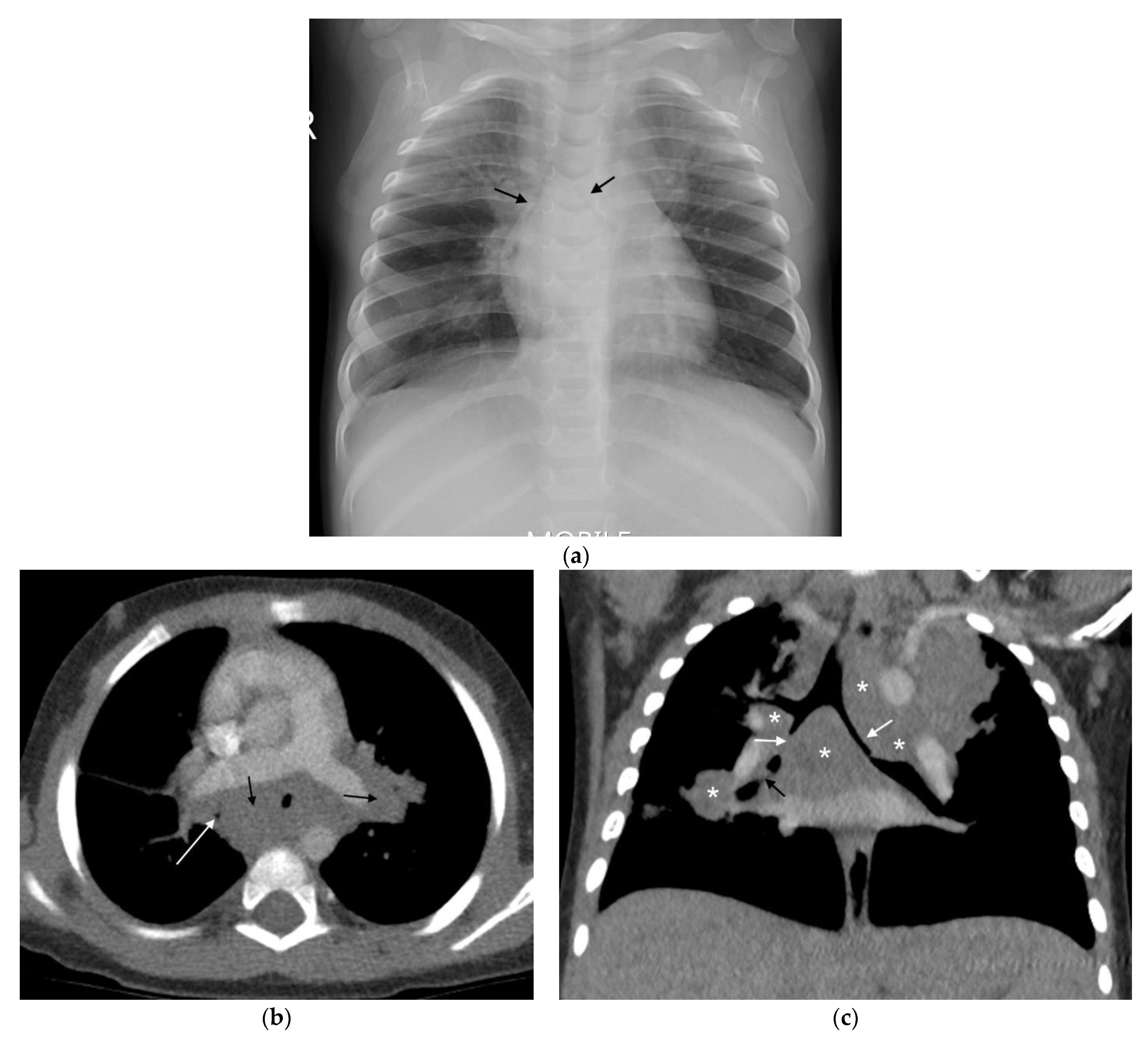 Chest Imaging for Pulmonary TB—An Update