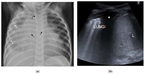Chest Imaging for Pulmonary TB—An Update