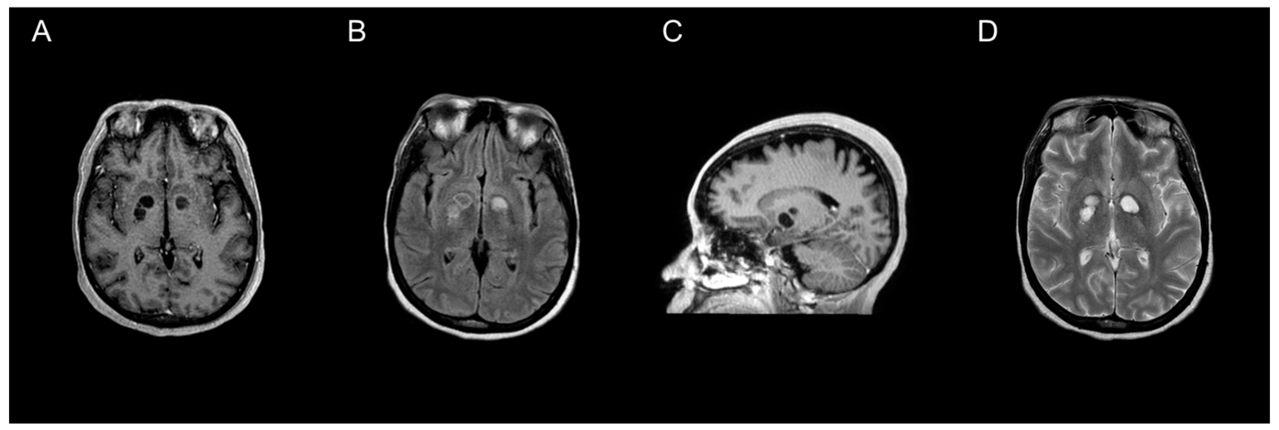 Cerebral Cryptococcomas: A Systematic Scoping Review of Available ...