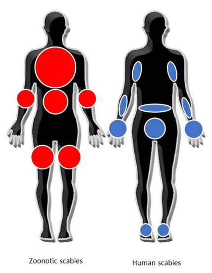 Zoonotic Episodes of Scabies: A Global Overview