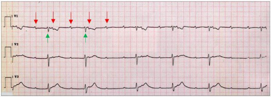 Pathogens | Free Full-Text | Lyme Carditis: From Pathophysiology to ...