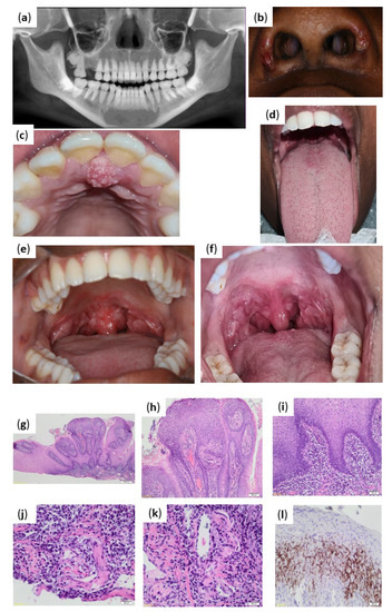 Oral Manifestations of Syphilis: Report of Four Cases
