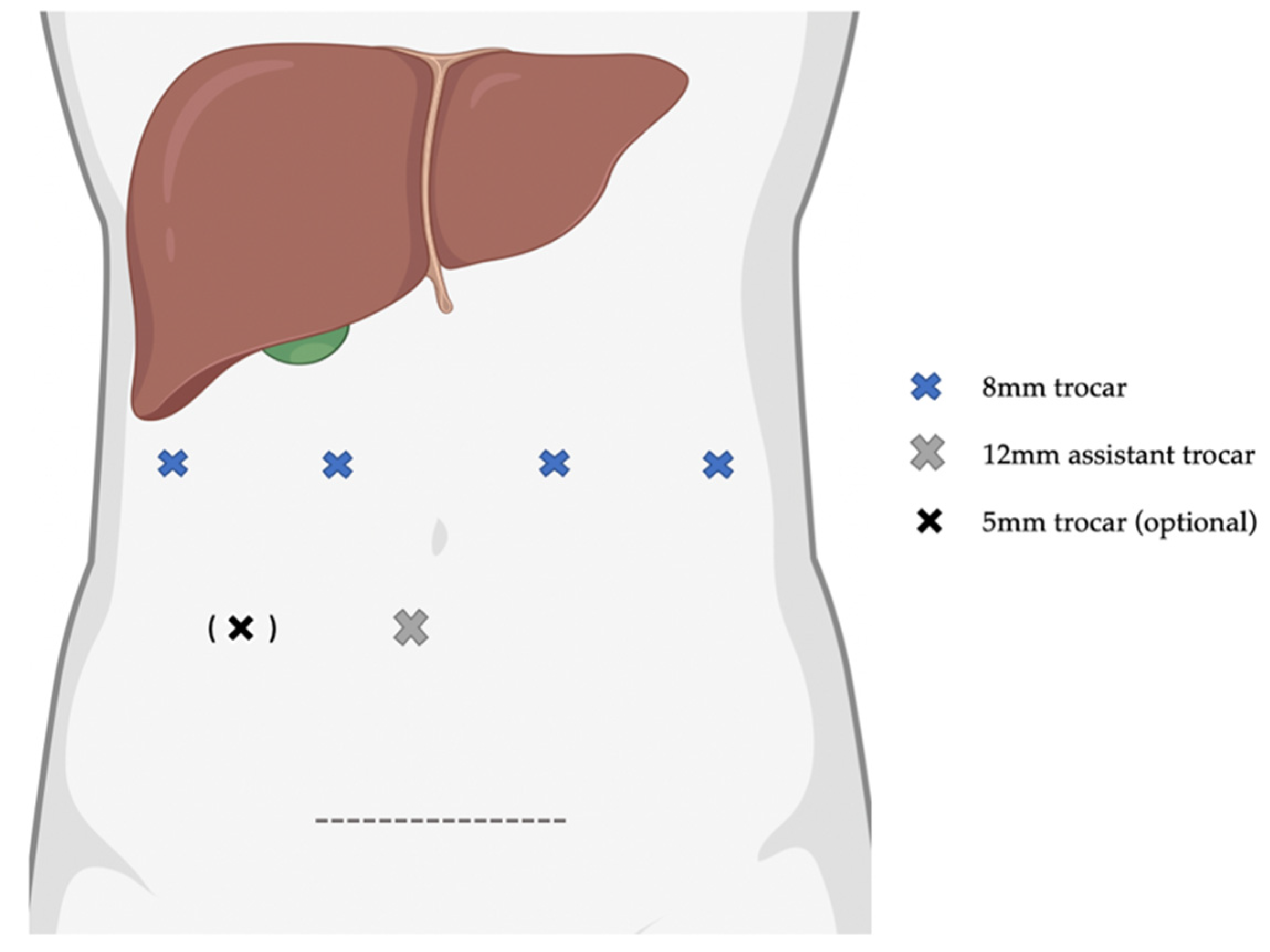 Robotic Liver Surgery for Alveolar Echinococcosis: A Single-Centre ...