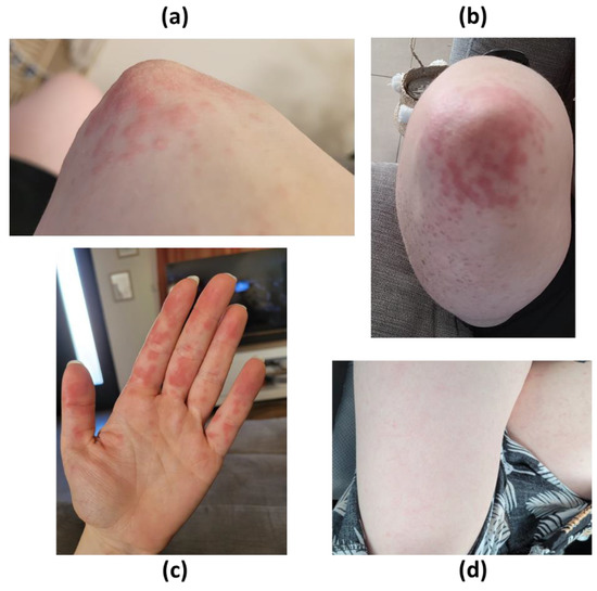 Cytomegalovirus-Associated Gianotti-Crosti Syndrome in 28-Year-Old ...