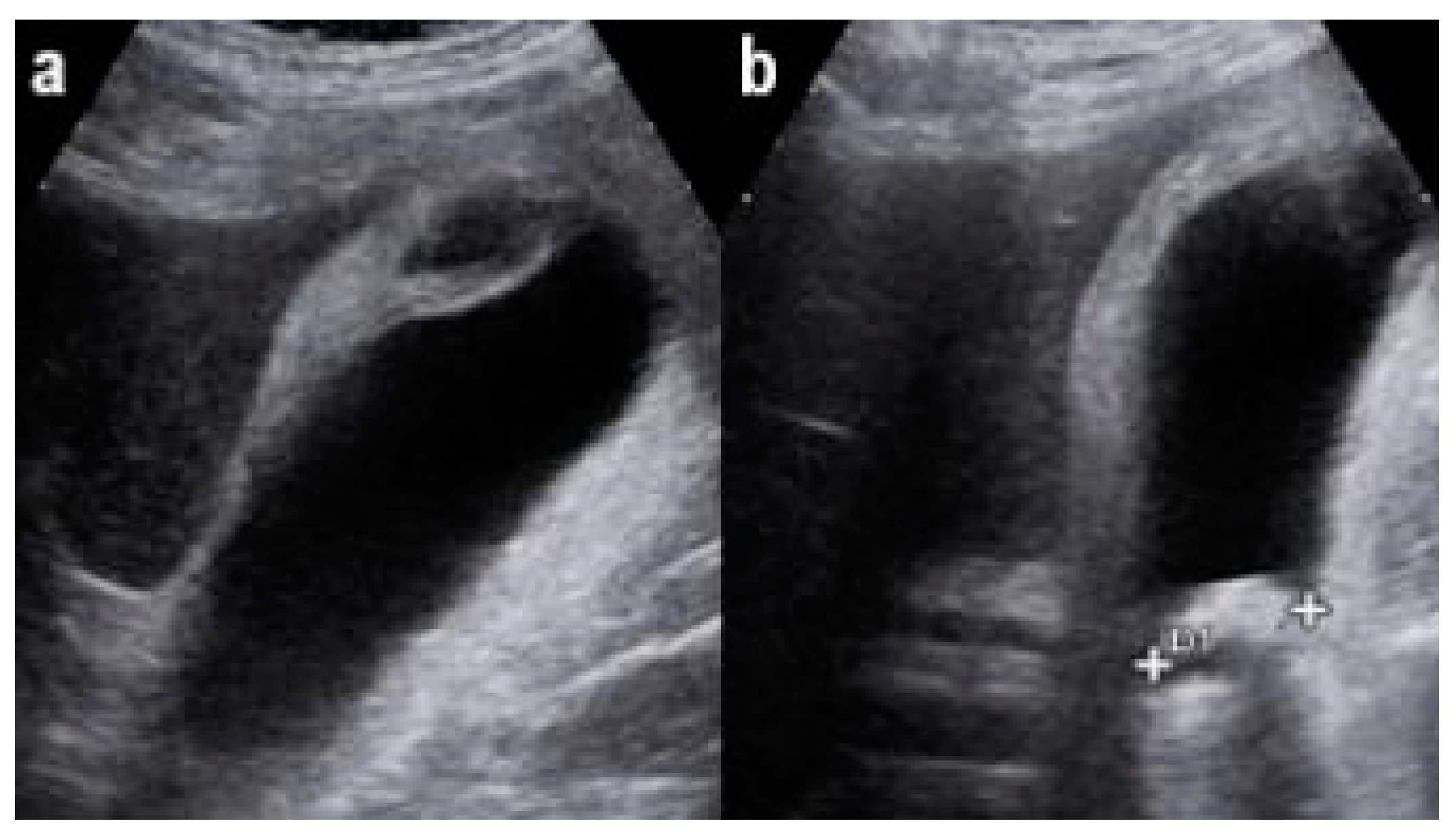Biliary Sepsis Due to Recurrent Acute Calculus Cholecystitis (ACC) in a High Surgical-Risk ...