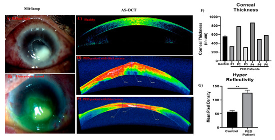 Prolonged Inflammation and Infectious Changes in the Corneal Epithelium ...