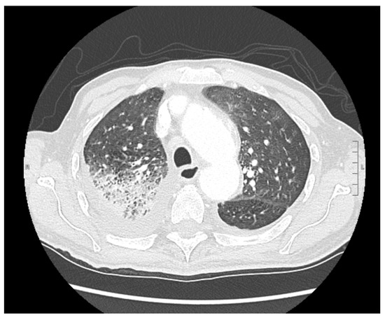 Mucorales/Fusarium Mixed Infection in Hematologic Patient with COVID-19 ...