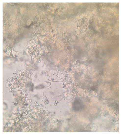 Mucorales/Fusarium Mixed Infection in Hematologic Patient with COVID-19 ...