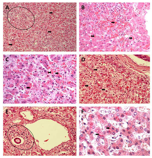 Comparative Analysis of Human Hepatic Lesions in Dengue, Yellow Fever ...