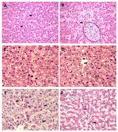 Comparative Analysis of Human Hepatic Lesions in Dengue, Yellow Fever ...