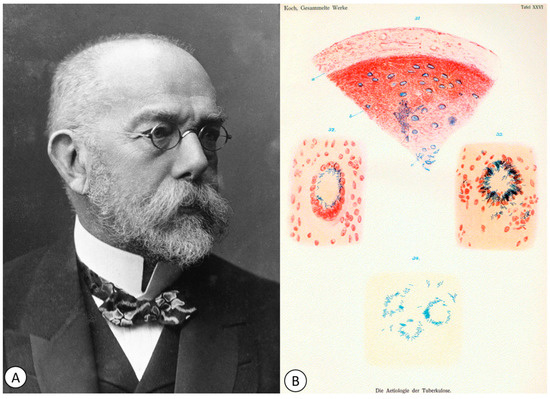 Brain Tuberculosis: An Odyssey through Time to Understand This Pathology