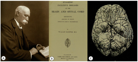 Brain Tuberculosis: An Odyssey through Time to Understand This Pathology